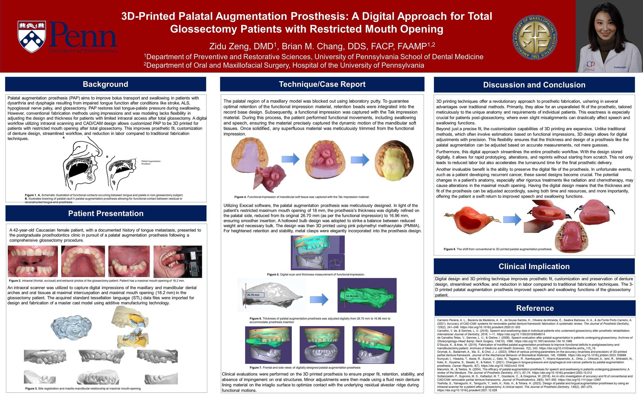 3D-Printed Palatal Augmentation Prosthesis: A Digital Approach for ...